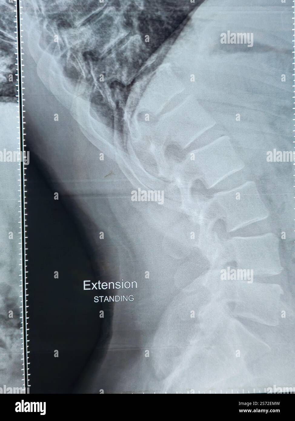 X-ray lumbosacral spine shows straightening of lumbar lordosis due to ...