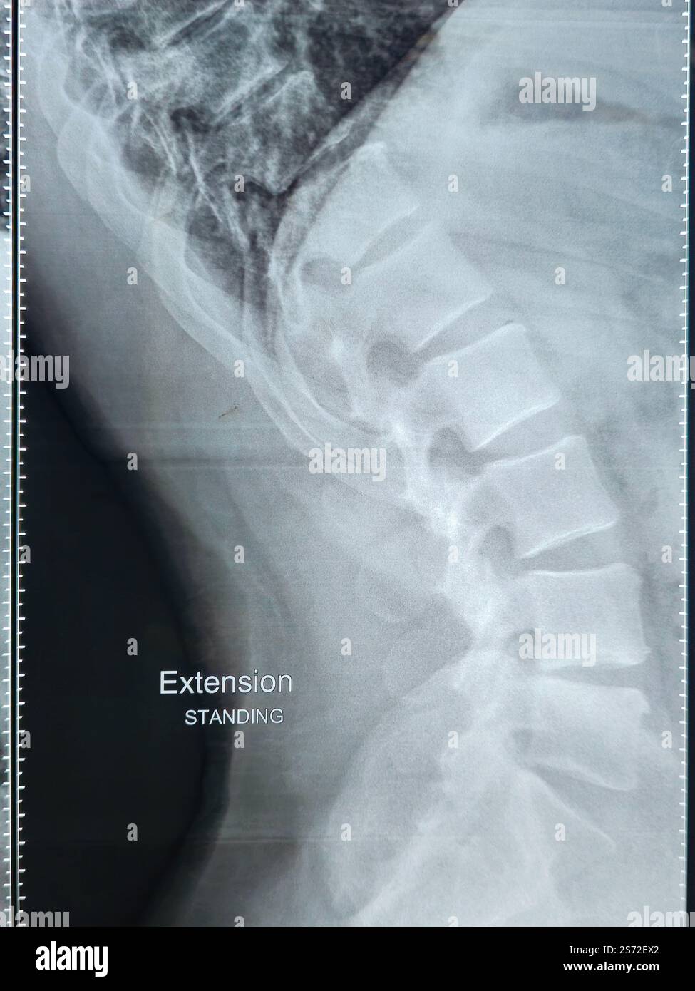 X-ray lumbosacral spine shows straightening of lumbar lordosis due to ...