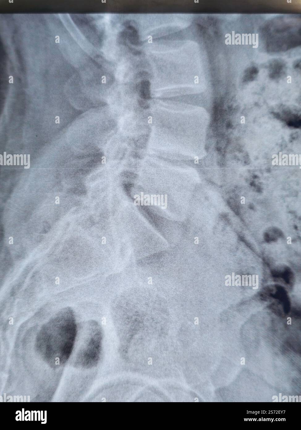 X-ray lumbosacral spine shows straightening of lumbar lordosis due to ...