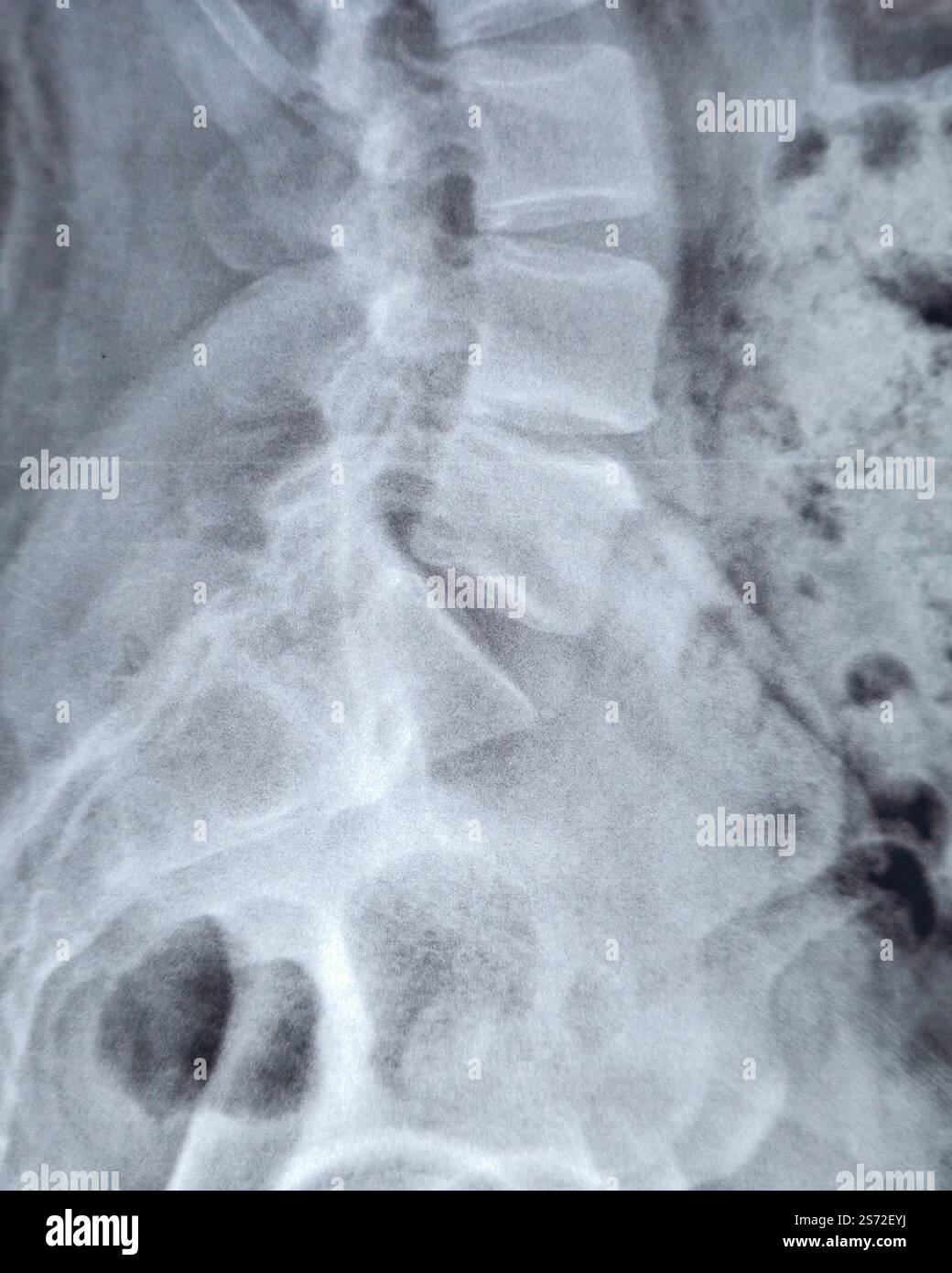 X-ray lumbosacral spine shows straightening of lumbar lordosis due to ...