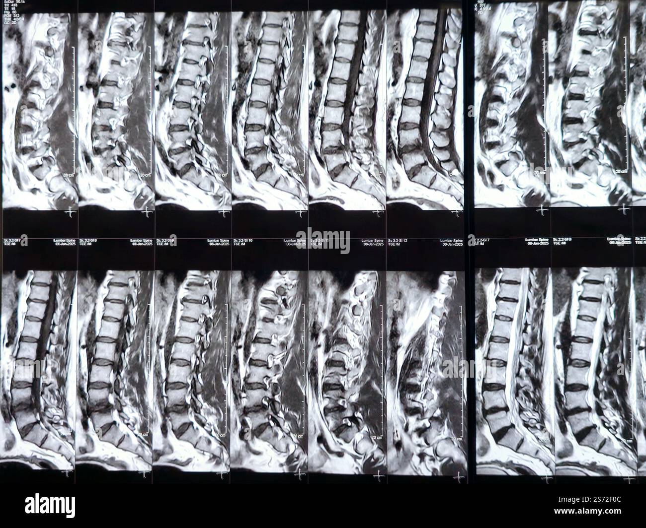 Magnetic Resonance Imaging MRI of the lumbosacral spine shows ...