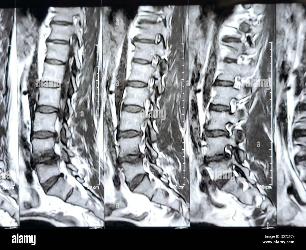 Magnetic Resonance Imaging MRI of the lumbosacral spine shows ...