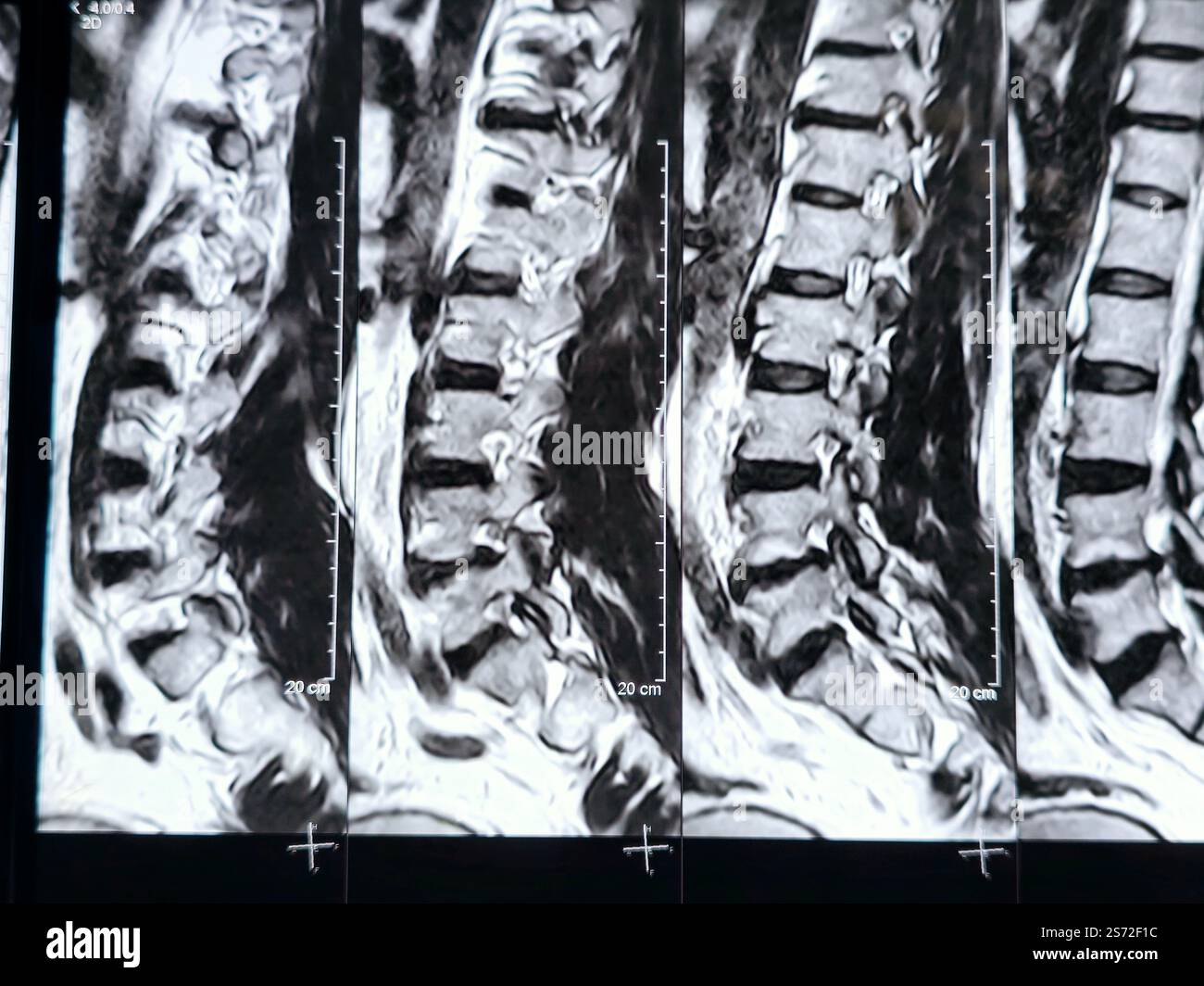 Magnetic Resonance Imaging MRI of the lumbosacral spine shows ...