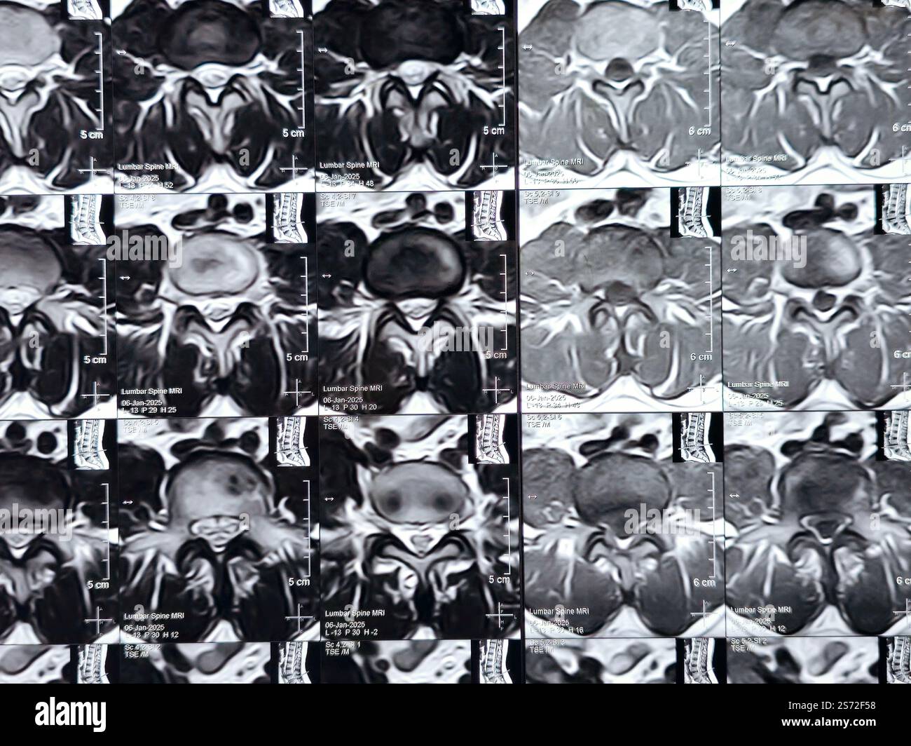 Magnetic Resonance Imaging MRI of the lumbosacral spine shows Spondylodegenerative changes of ...