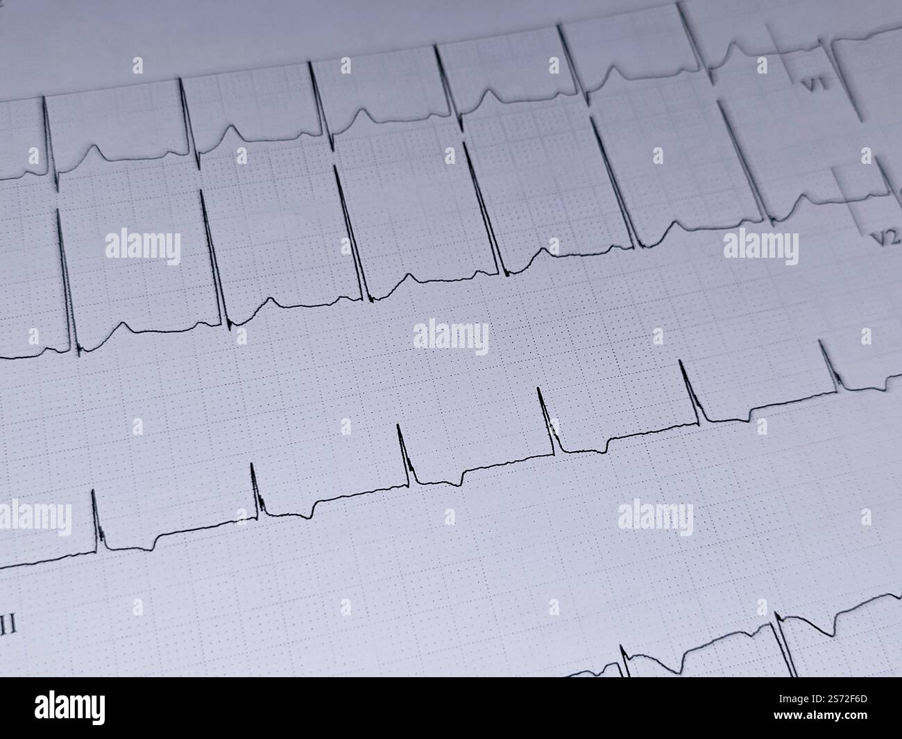 an electrocardiogram ECG or EKG, within normal ECG for a 55 years old ...