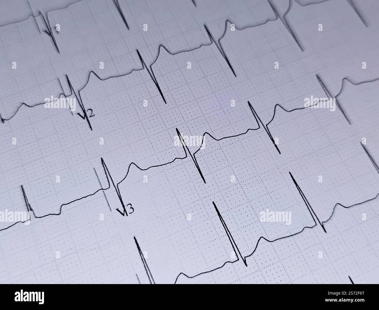 an electrocardiogram ECG or EKG, within normal ECG for a 55 years old ...