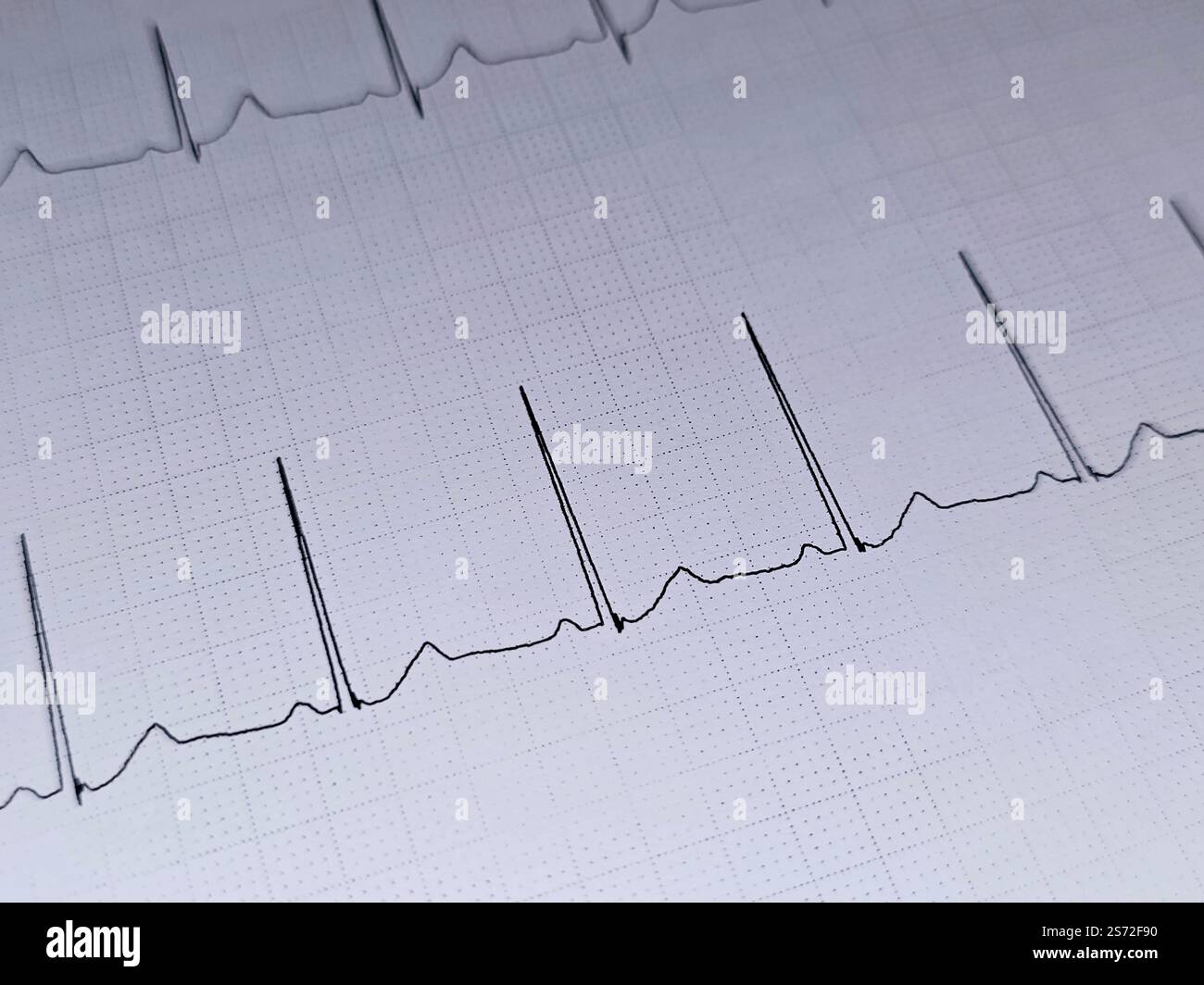 An Electrocardiogram Ecg Or Ekg Within Normal Ecg For A 55 Years Old