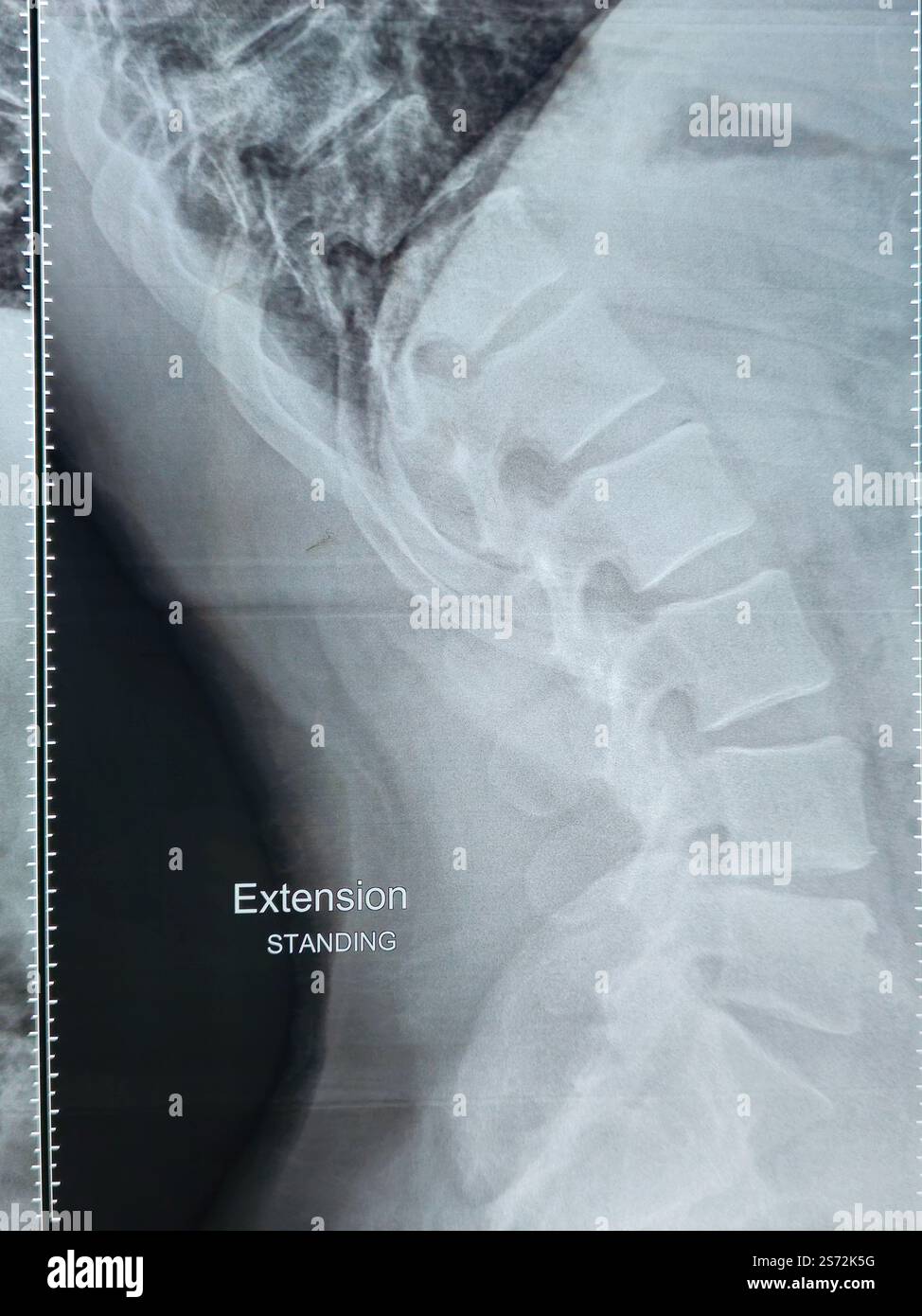 X-ray lumbosacral spine shows straightening of lumbar lordosis due to ...