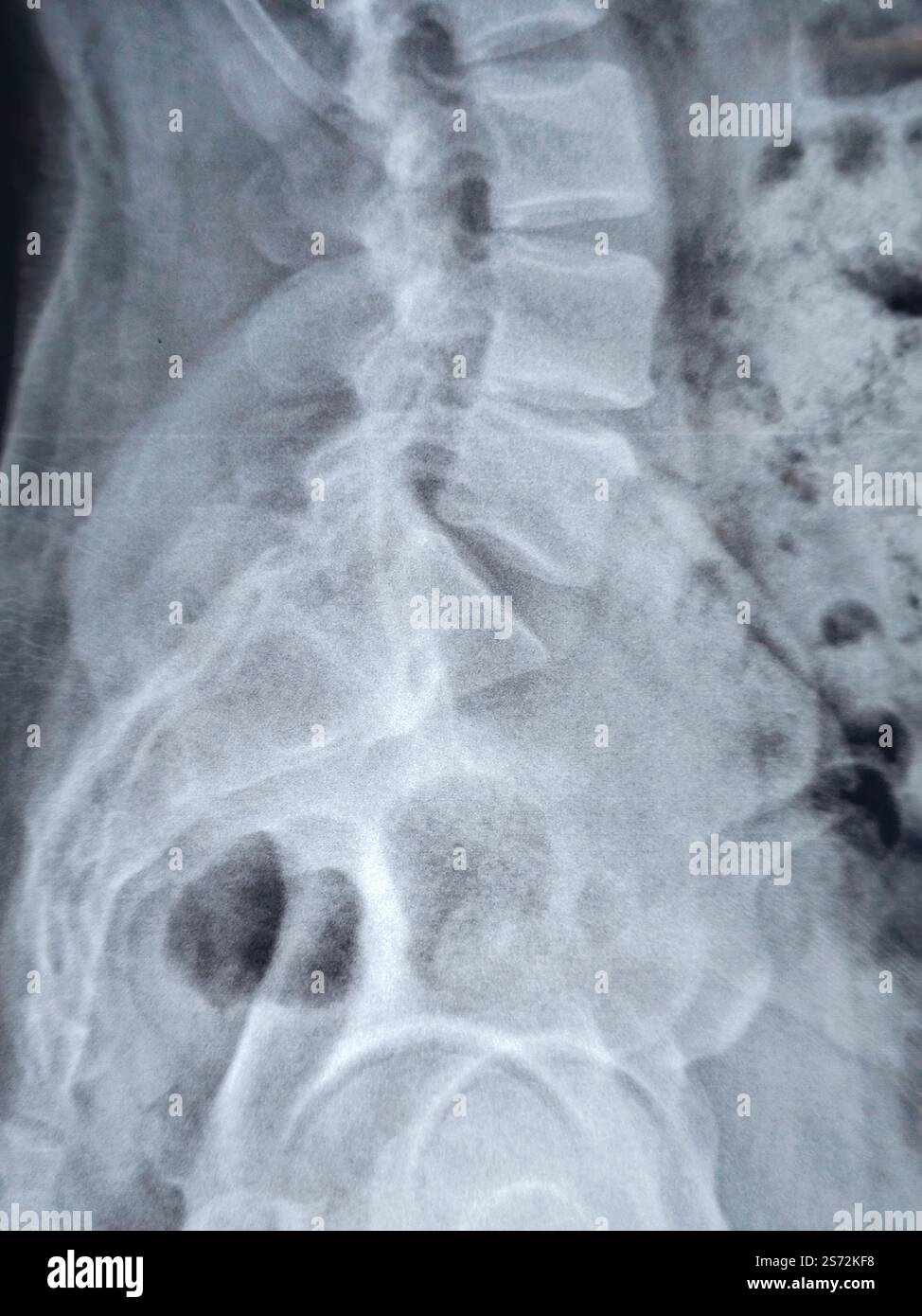X-ray lumbosacral spine shows straightening of lumbar lordosis due to ...