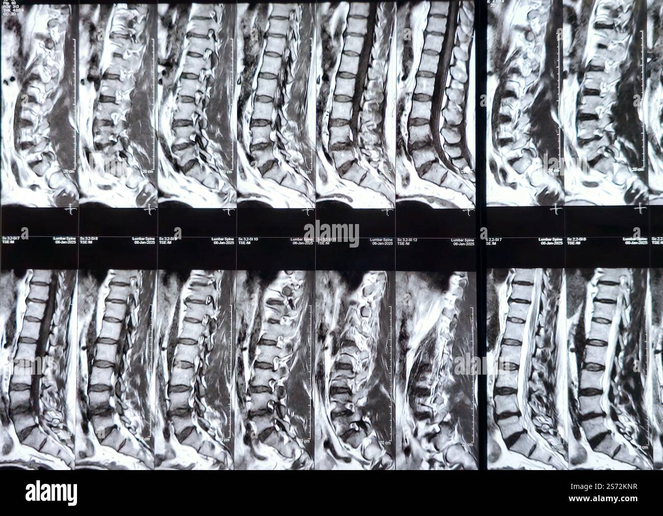 Magnetic Resonance Imaging MRI of the lumbosacral spine shows ...