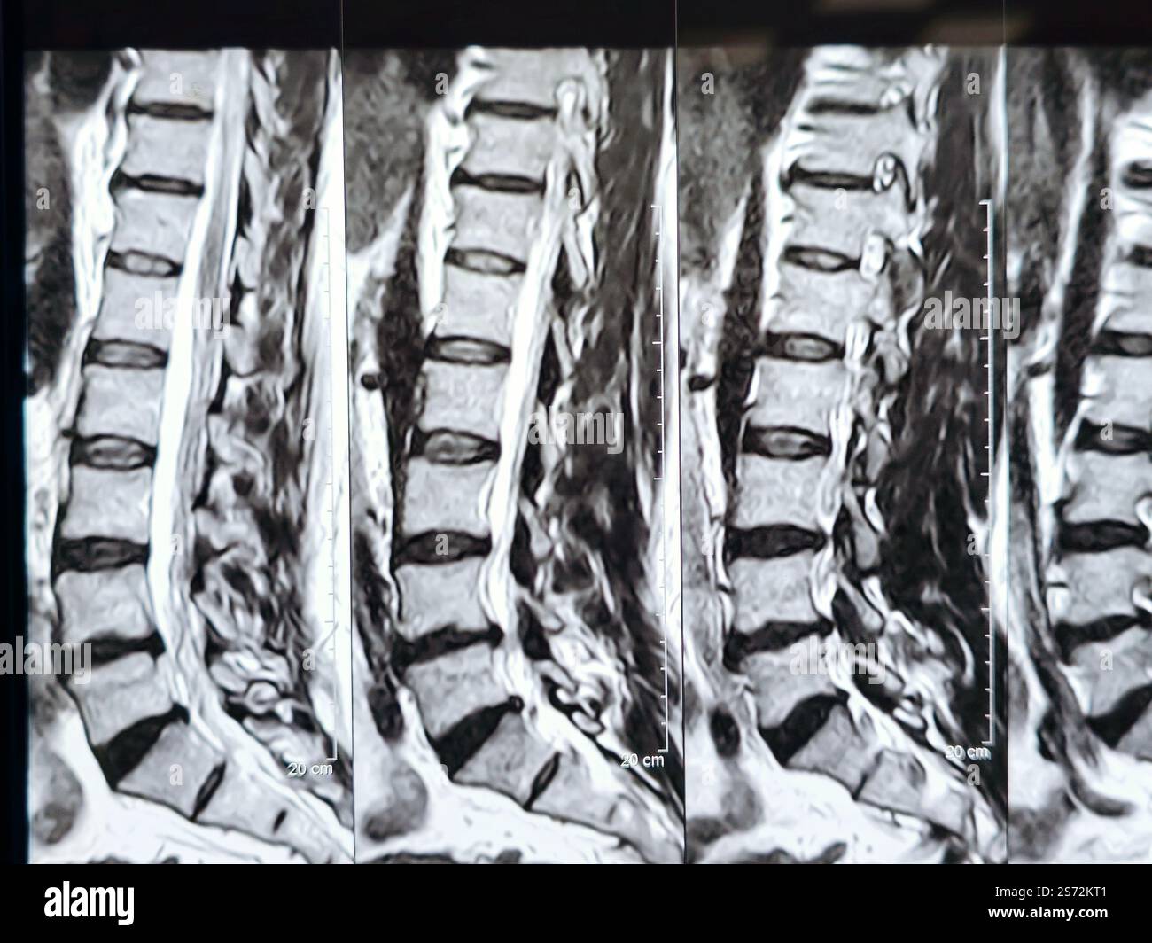Magnetic Resonance Imaging MRI of the lumbosacral spine shows Spondylodegenerative changes of ...