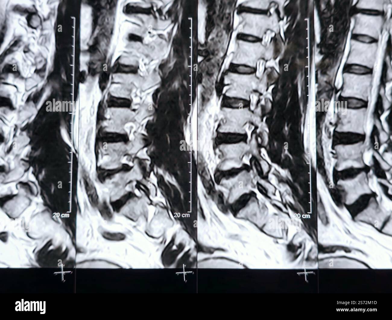 Magnetic Resonance Imaging MRI of the lumbosacral spine shows ...