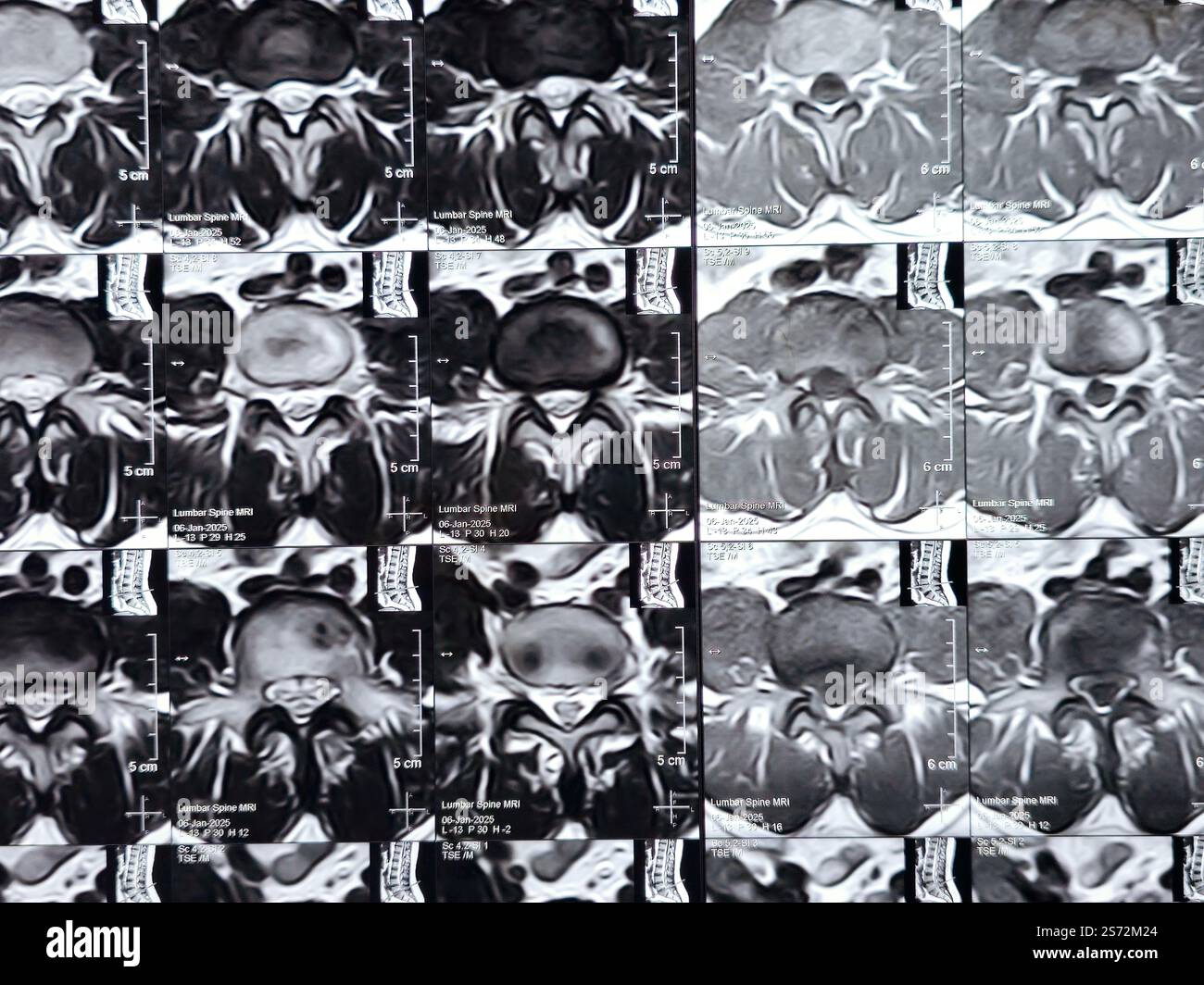 Magnetic Resonance Imaging MRI of the lumbosacral spine shows ...