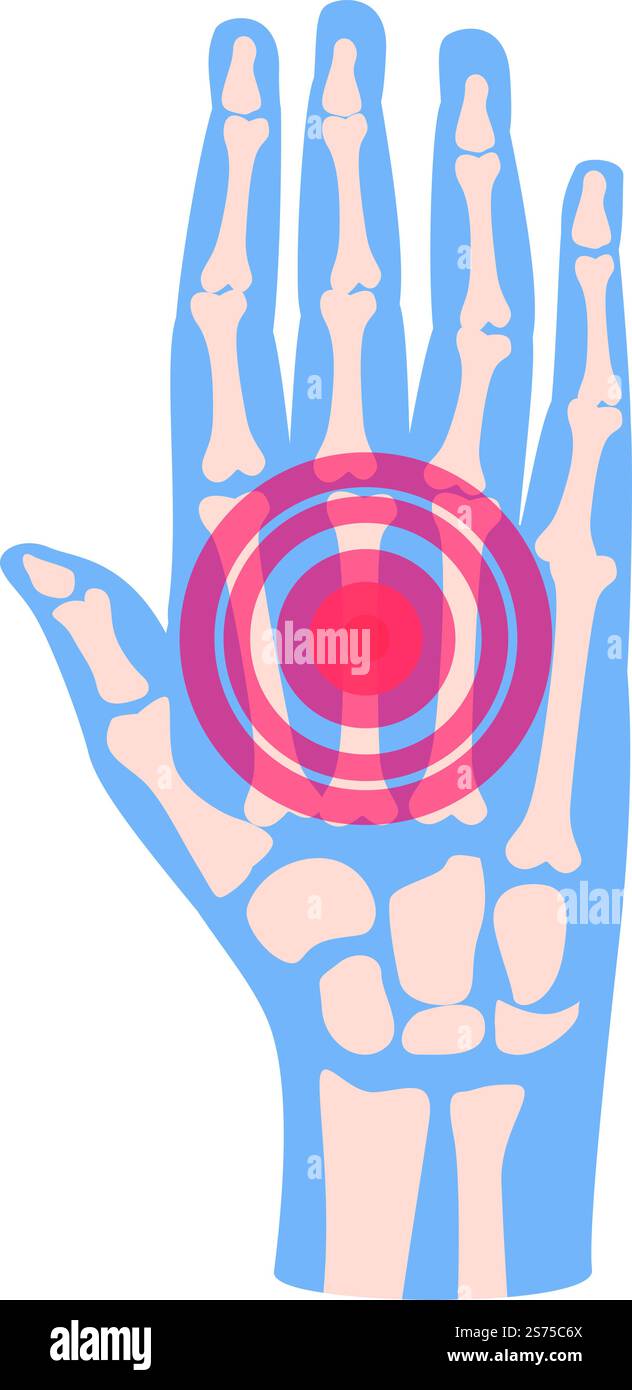 Hand pain icon cartoon vector. Arthritis joint. Medical patient. Hand ...