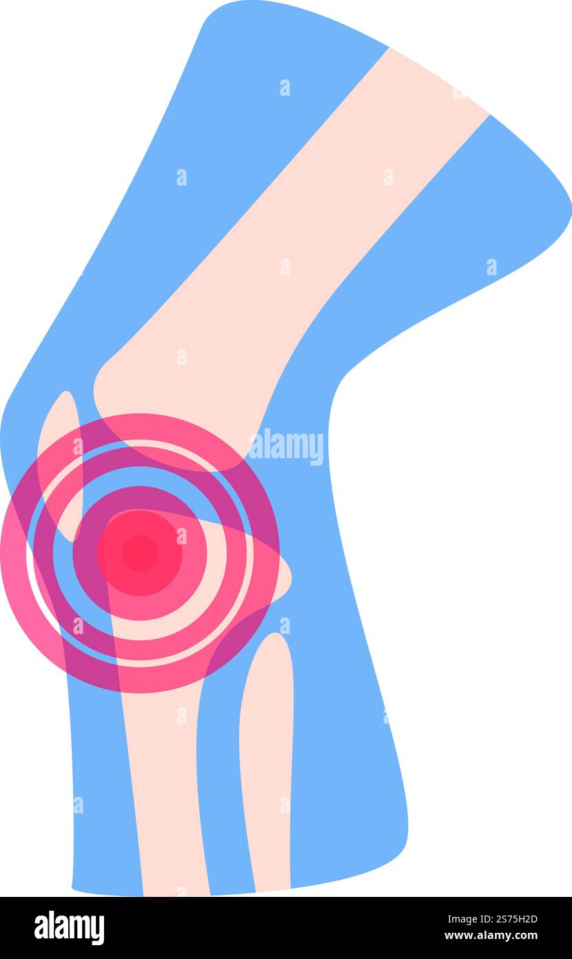 Articulation icon cartoon vector. Arthritis joint. Medical treatment ...