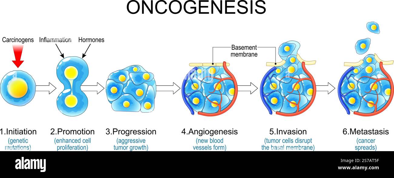 Carcinogenesis. Oncogenesis stages. Normal cells are transformed into cancer cells. Process of ...