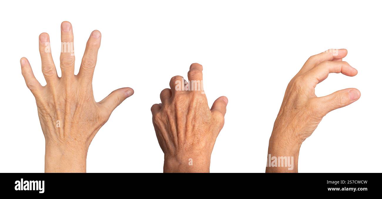 Dorsal view of an elderly woman's hand, outstretched with wrinkled skin ...