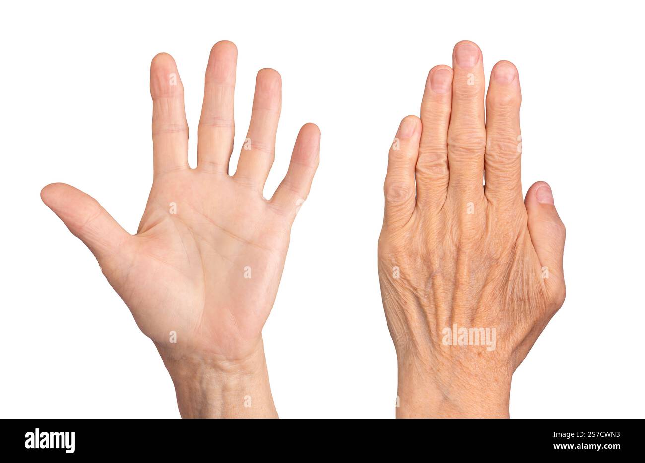 Closeup of elderly caucasian woman's hands, dorsal and palmar views ...