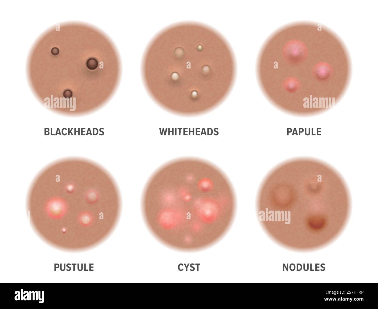 Acne Types On Dark Skin Face Pimples And Comedones Vector Blackheads Acne Types On Dark Skin Face Pimples And Comedones Vector Blackheads