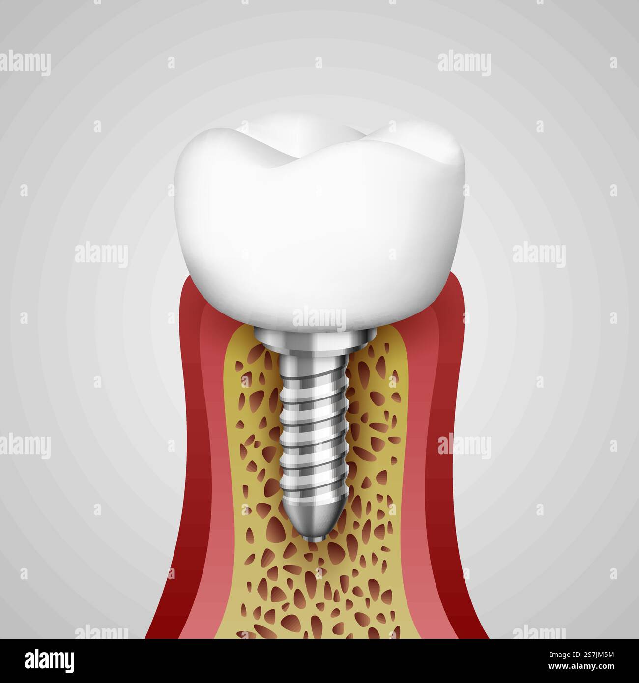 3d teeth in a cut with nerve endings and with an implant. Vector ...