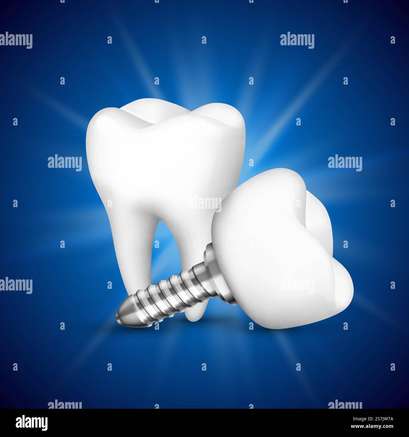 Tooth implant on a blue background. Vector illustration Stock Vector ...