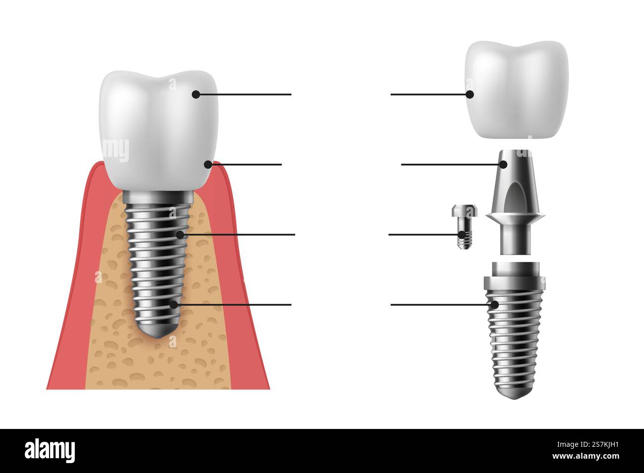 Tooth implant. Realistic implant structure pictorial models crown ...