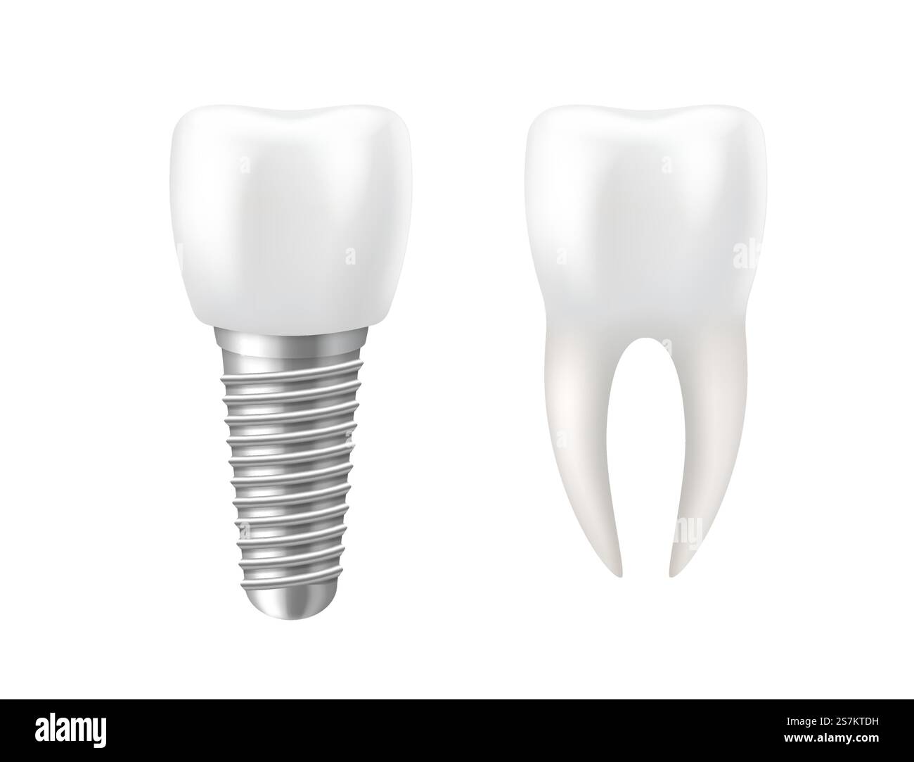 Realistic tooth and dental implant for stomatology or dentistry ...