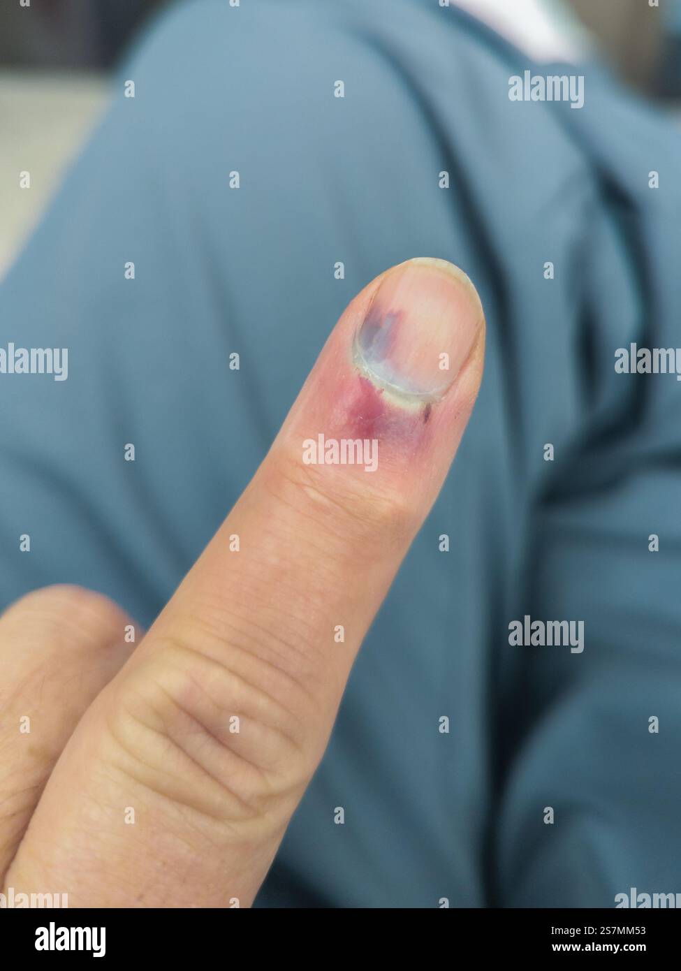 Ecchymosis hand hi-res stock photography and images - Alamy