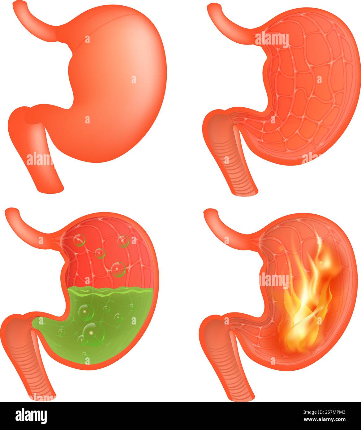 Medical illustration of realistic stomach outside and inside. Gastritis ...