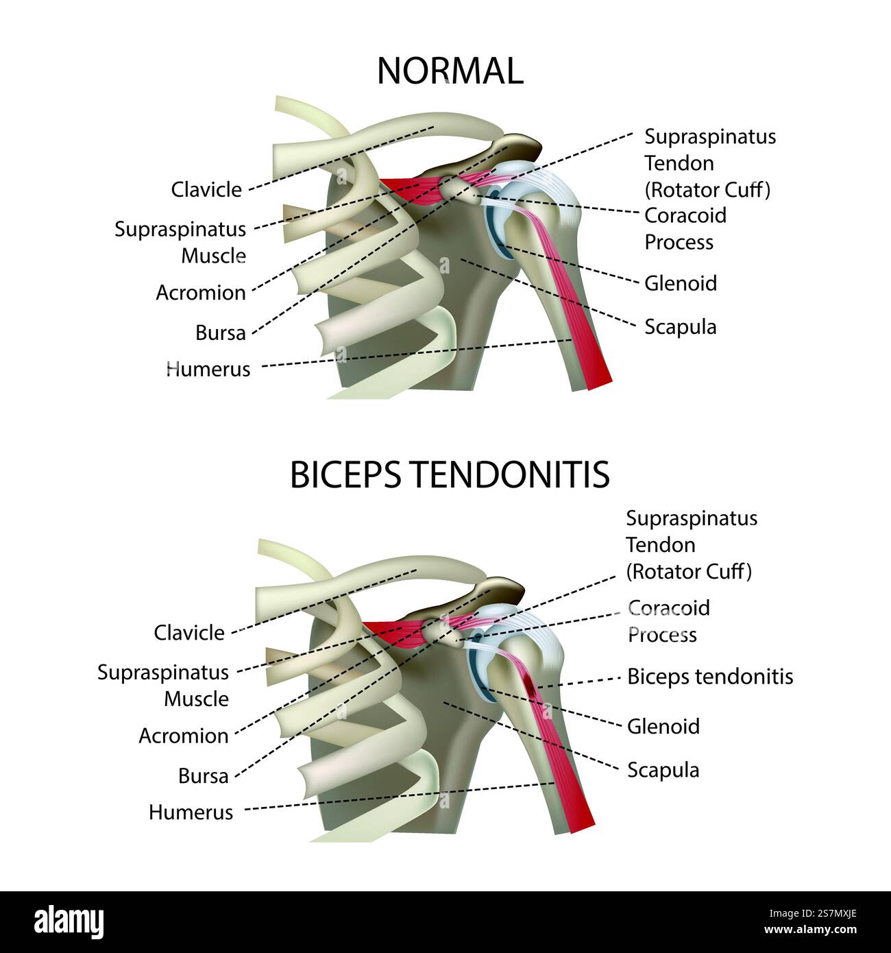 Shoulder joint realistic vector biceps tendonitis hi-res stock ...