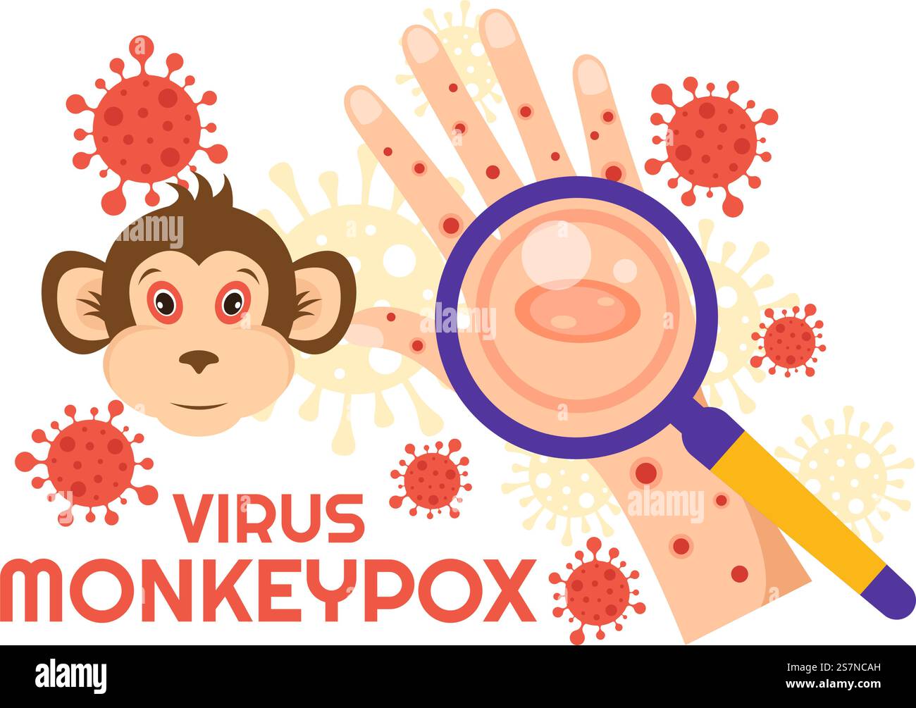 Monkey Pox Outbreak Vector Illustration of Virus Symptoms in Humans ...