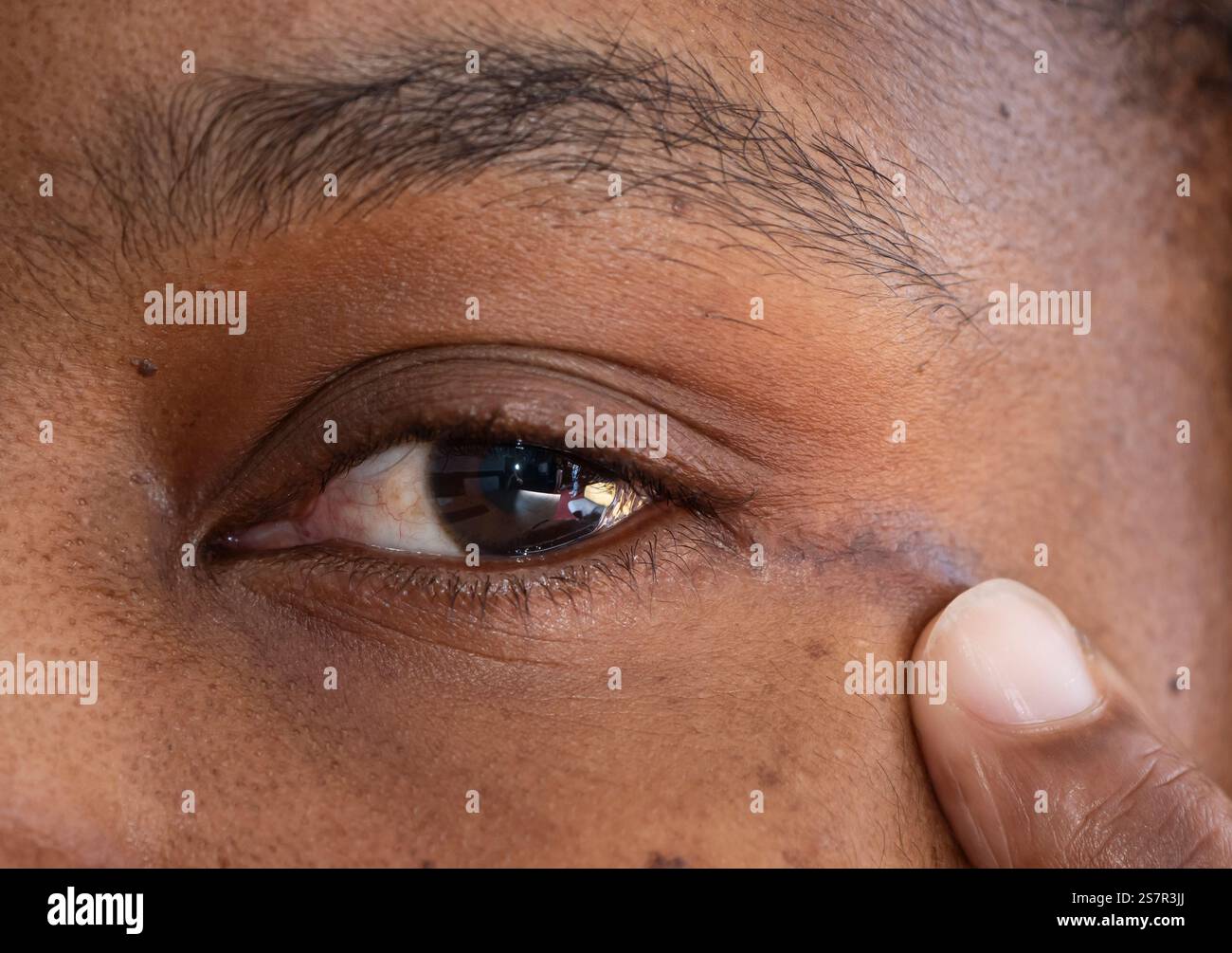 A small scar at the corner of Ruvimbo Kaviya's eye after she became the ...