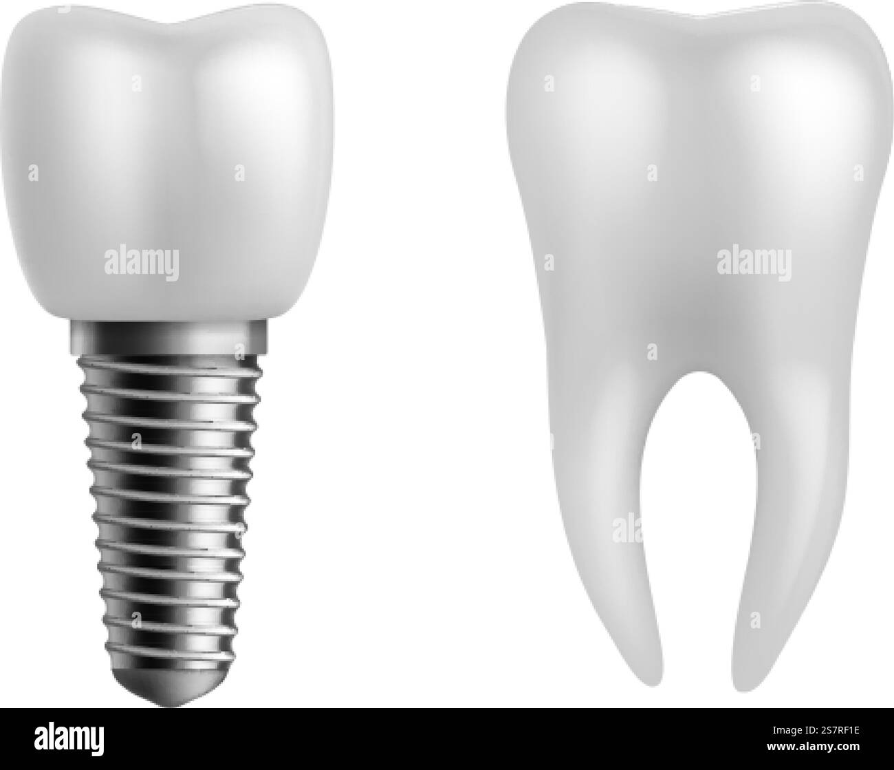 Dental implant and teeth. Realistic orthodontic elements. Human white ...