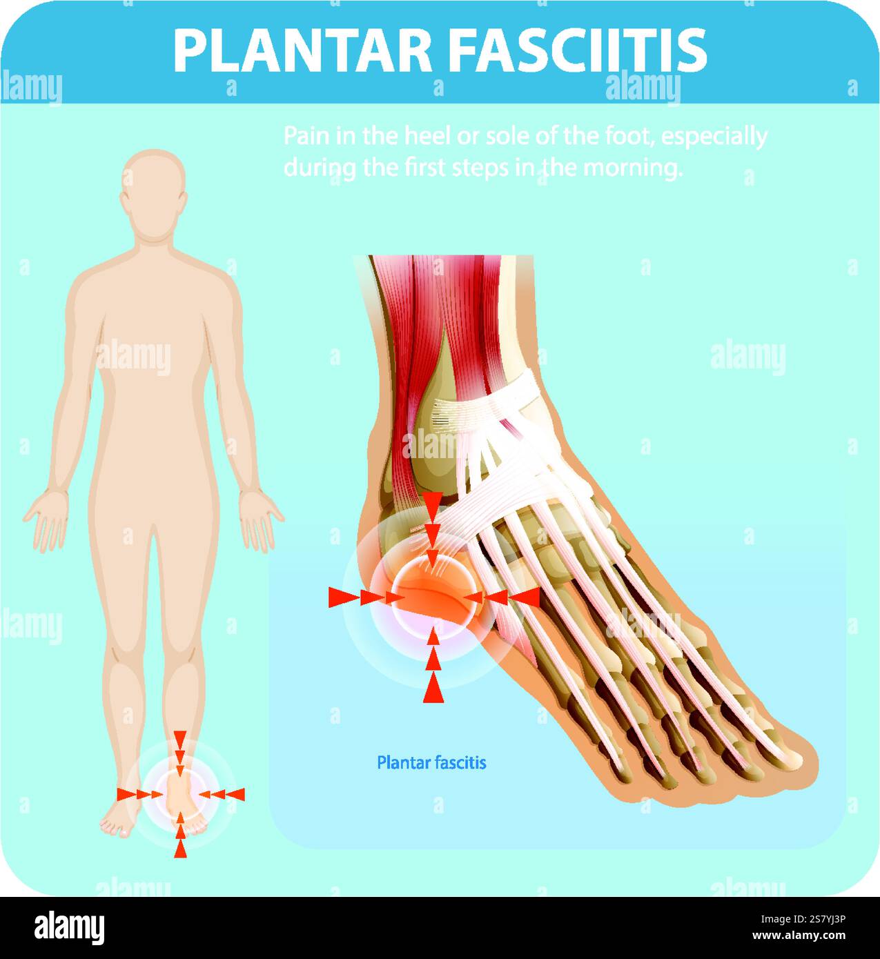 Illustration of foot pain and anatomical structure Stock Vector Image ...