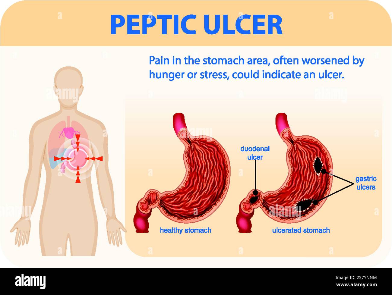 Illustration Of Stomach Ulcers And Related Symptoms Stock Vector Image 6969