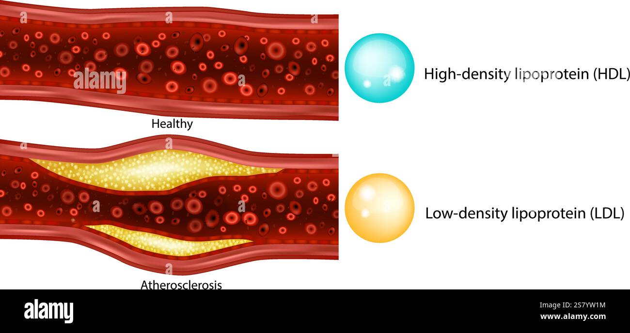 Cholesterol. Low-density lipoprotein High-density lipoprotein ...