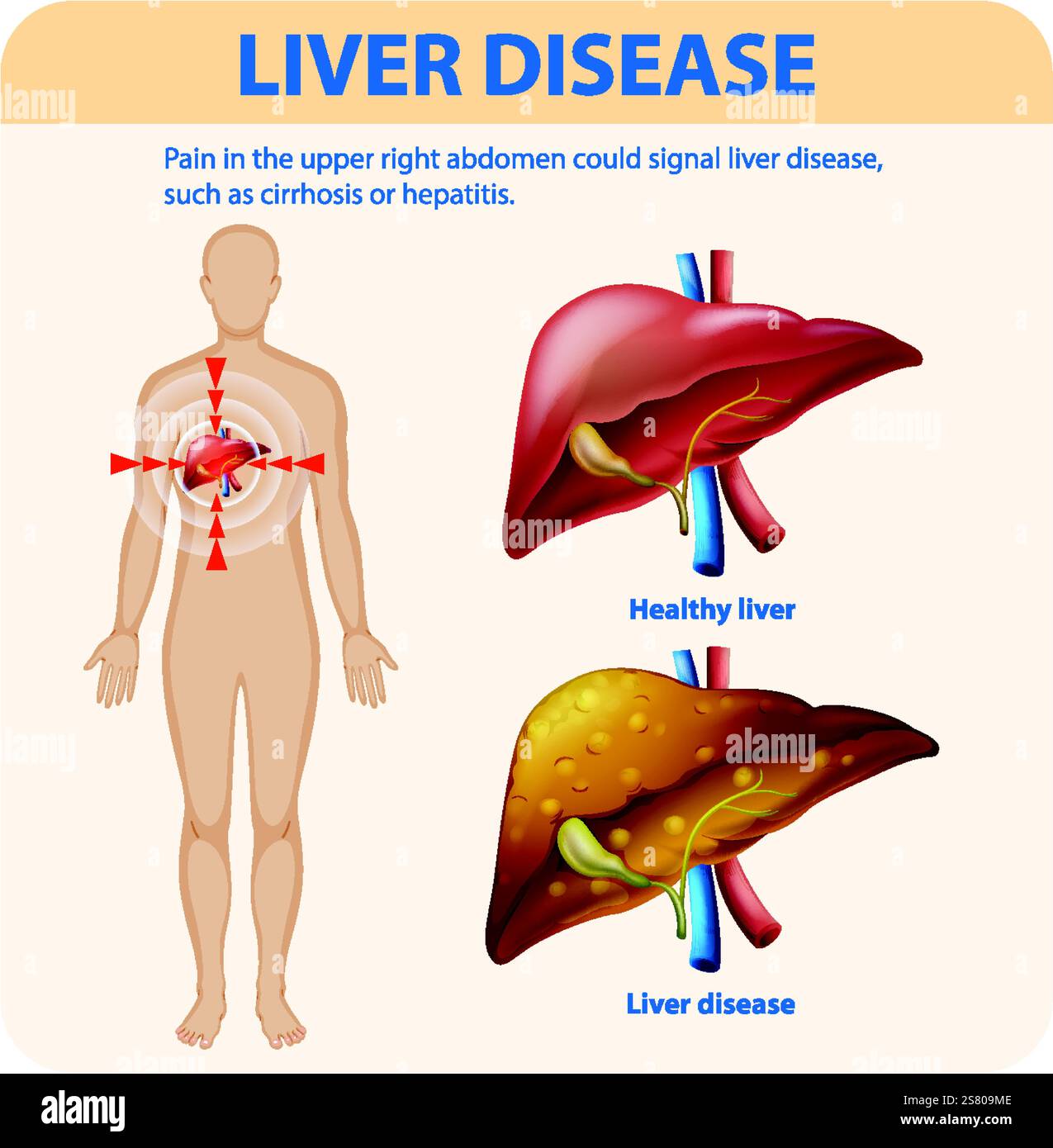 Illustration of healthy and diseased liver comparison Stock Vector ...