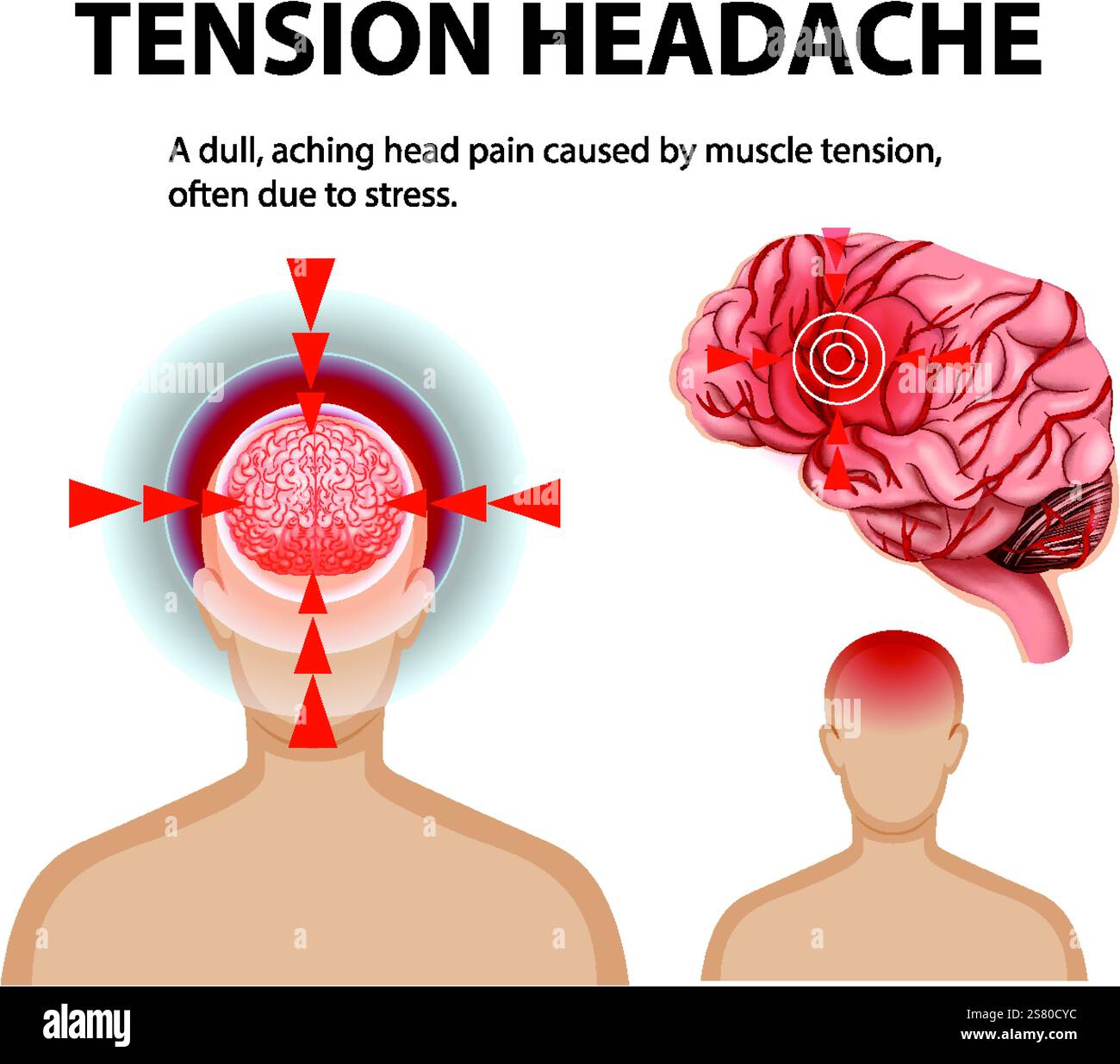 Illustration of tension headache causes and symptoms Stock Vector Image & Art - Alamy
