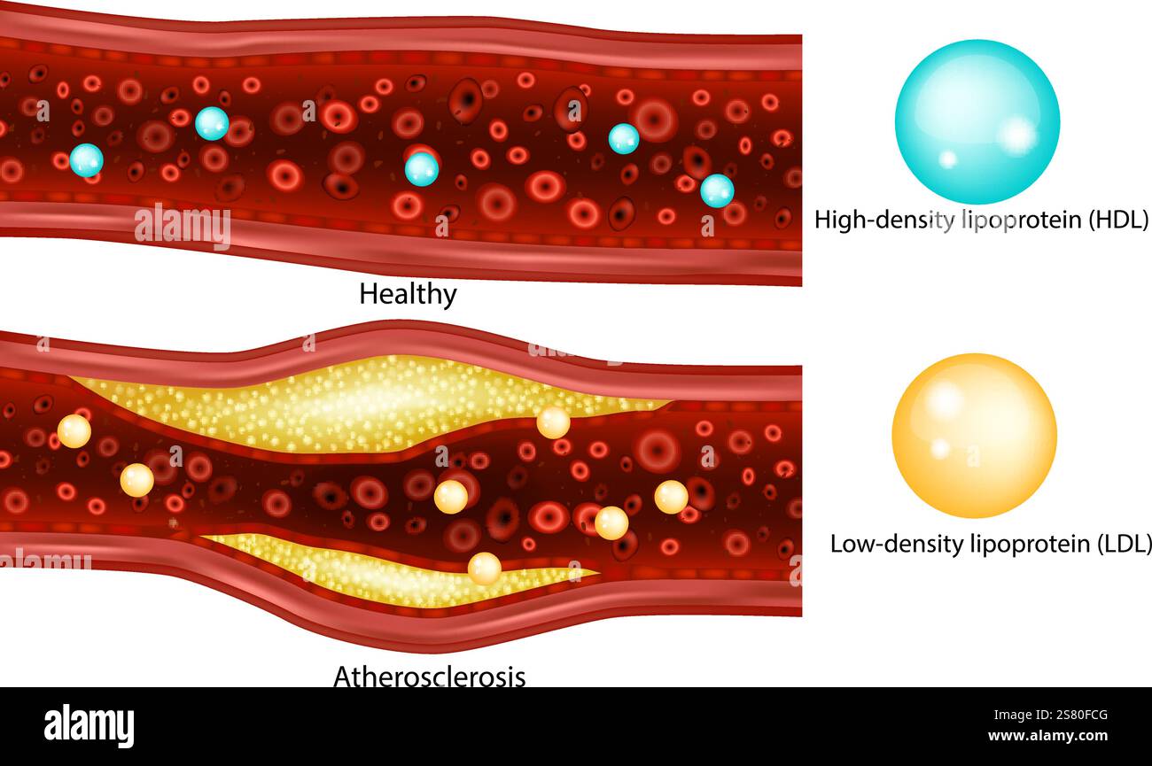 Cholesterol. Low-density lipoprotein High-density lipoprotein ...
