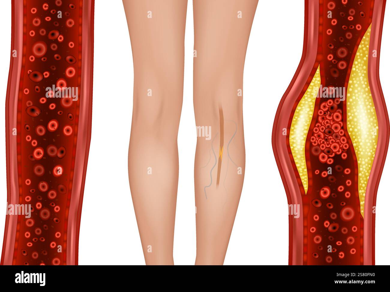 Atherosclerosis of the Lower Extremities. Leg Artery Disease ...