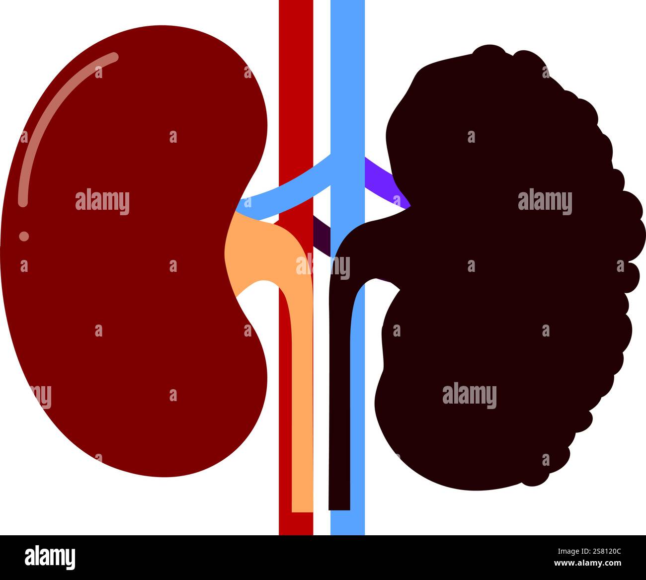 Healthy kidney and unhealthy disease kidney with polycystic. Check ...