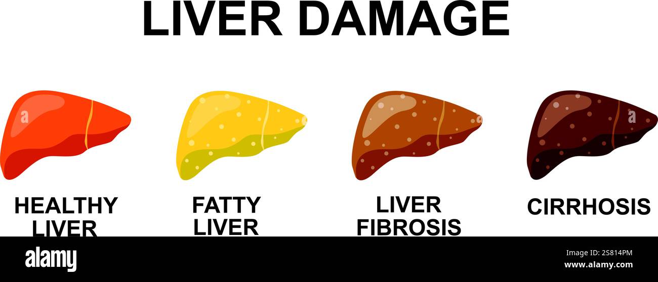 Stages of nonalcoholic liver damage. Healthy, fatty, fibrosis ...