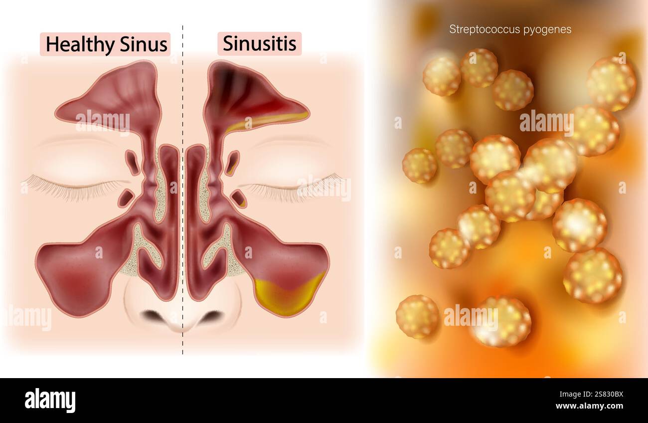 Comparison of Healthy Sinus and Sinusitis with Streptococcus Pyogenes . Sinus Bacterial ...