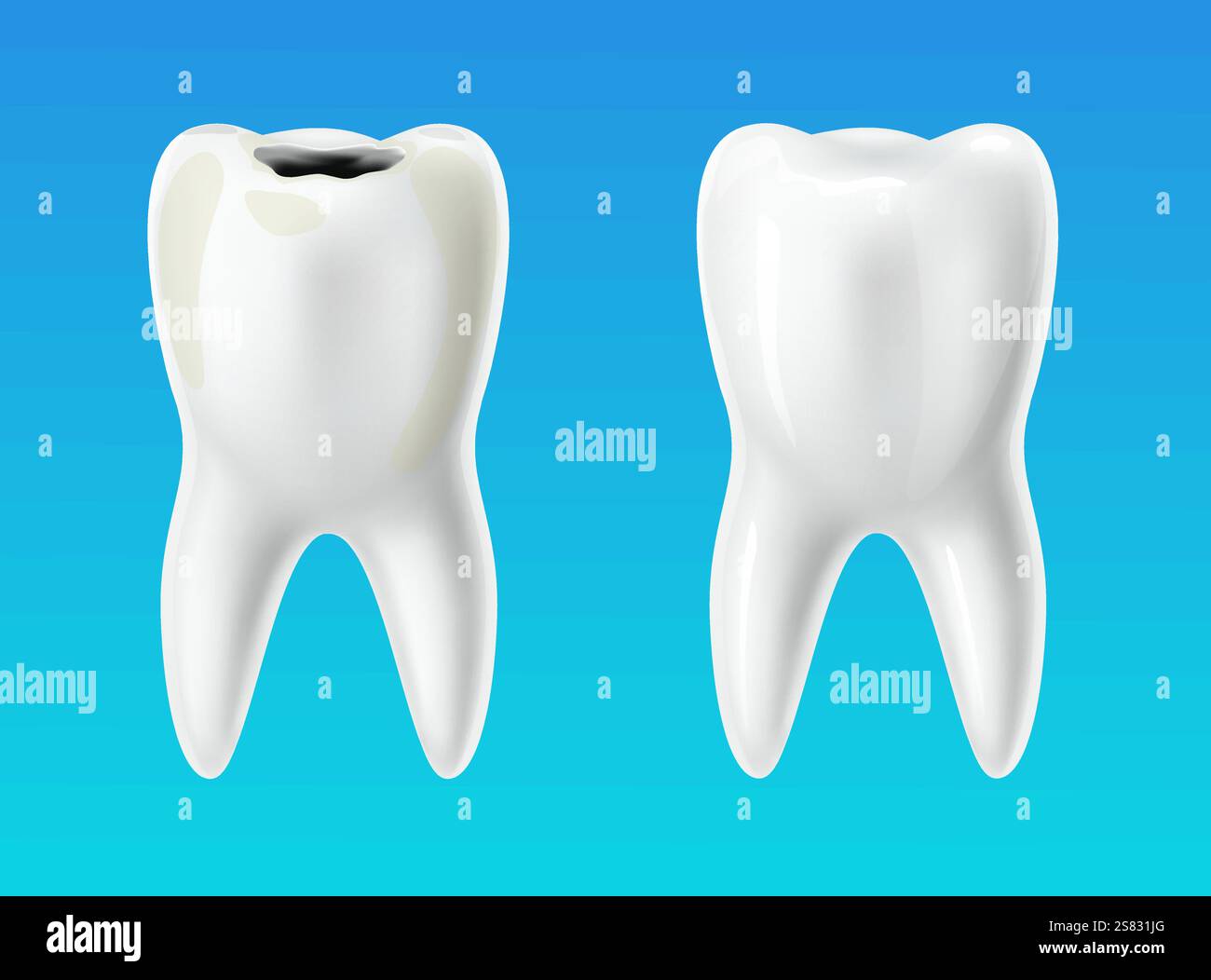 Healthy tooth and decayed tooth. 3D isolated teeth, caries professional ...