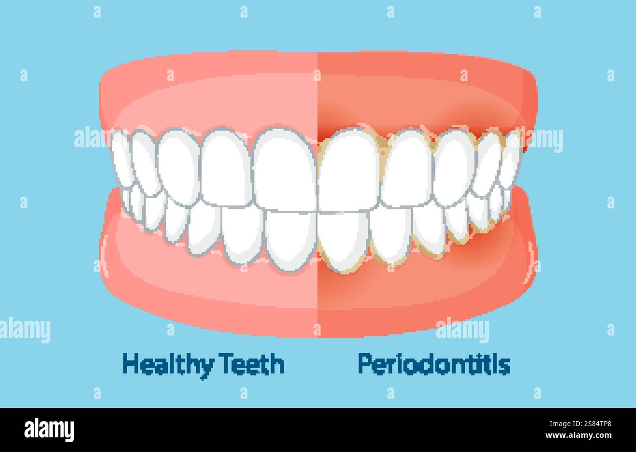 Illustration showing healthy teeth versus periodontitis effects Stock ...