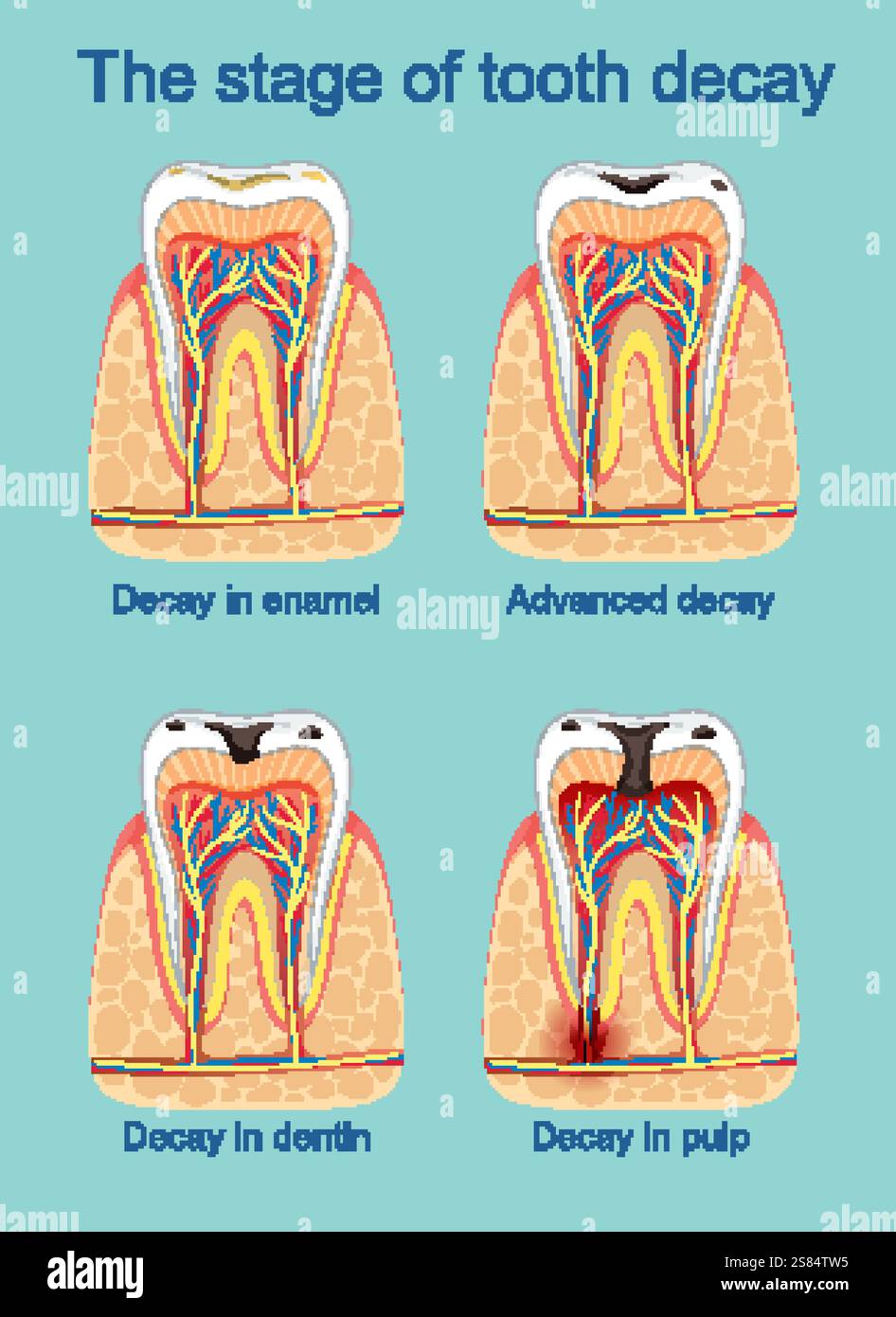 Stages of tooth decay hi-res stock photography and images - Alamy