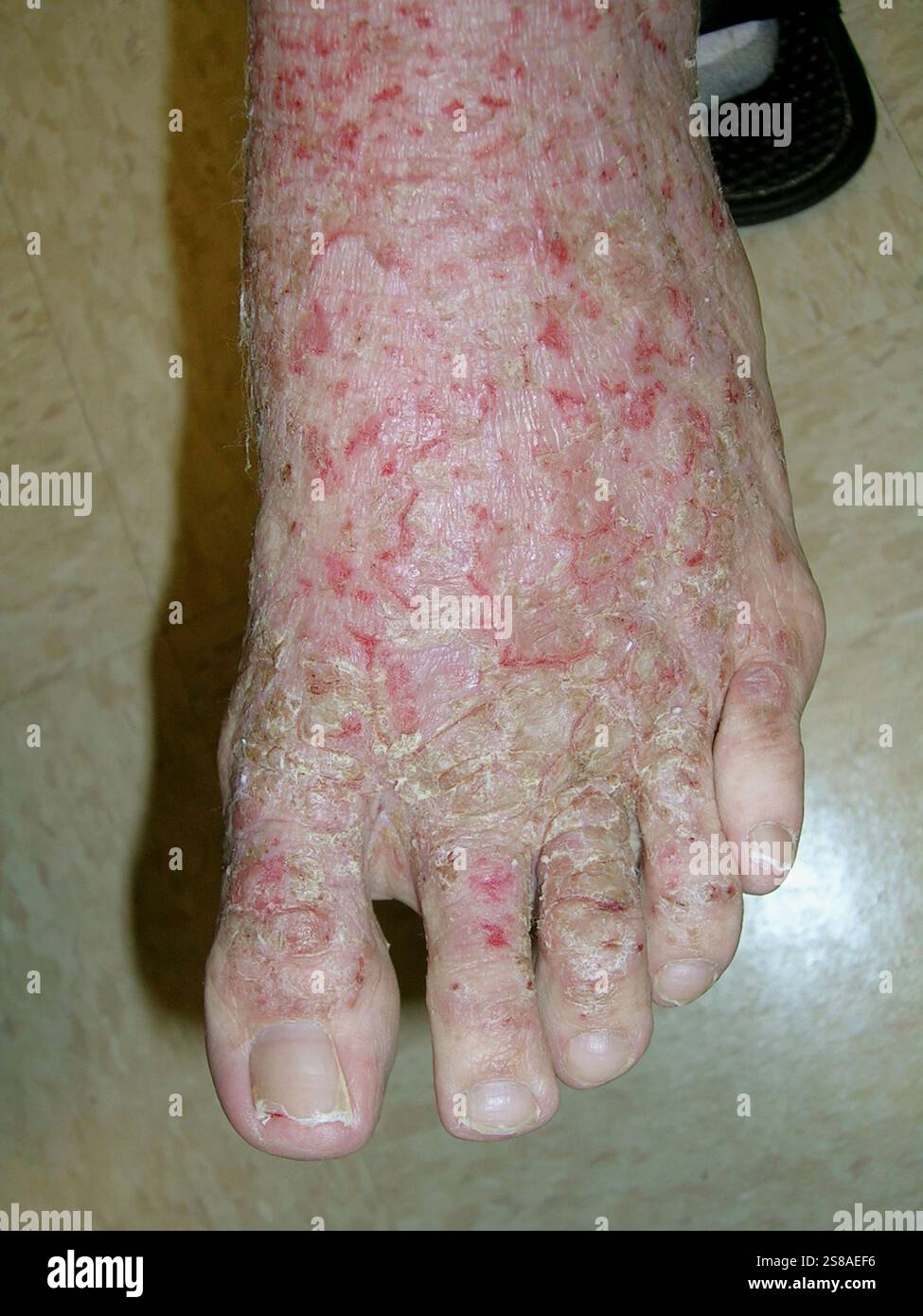 Not to be used for advertising or in a defamatory context Erythrodermic ...