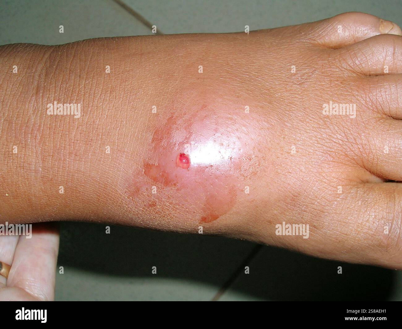 Not to be used for advertising or in a defamatory context Abscess on a ...