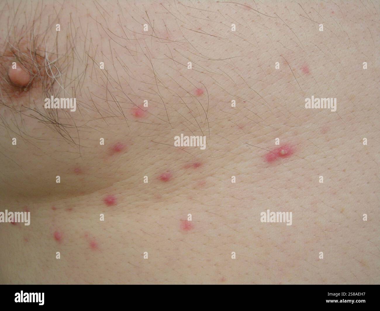 Not to be used for advertising or in a defamatory context Folliculitis ...