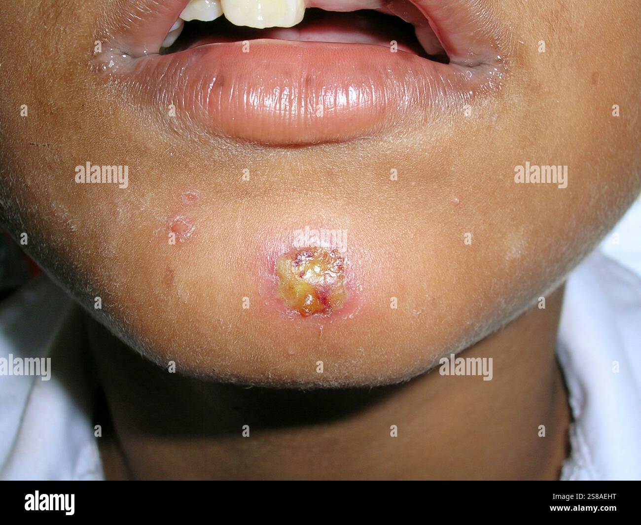 Not to be used for advertising or in a defamatory context Impetigo on a ...